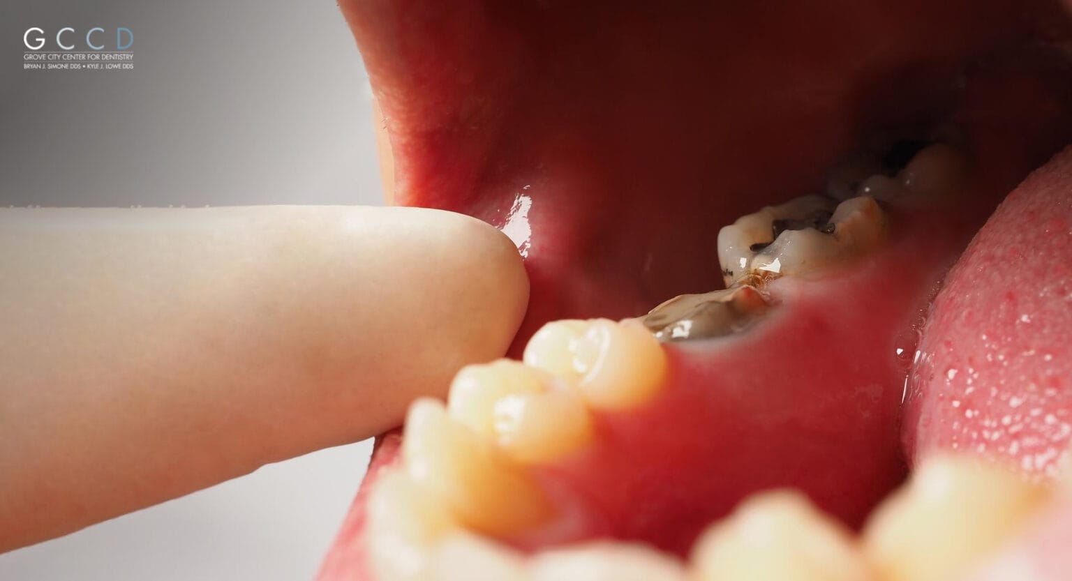 Complete Guide to Cavity Prevention for All Ages: What Actually Works?